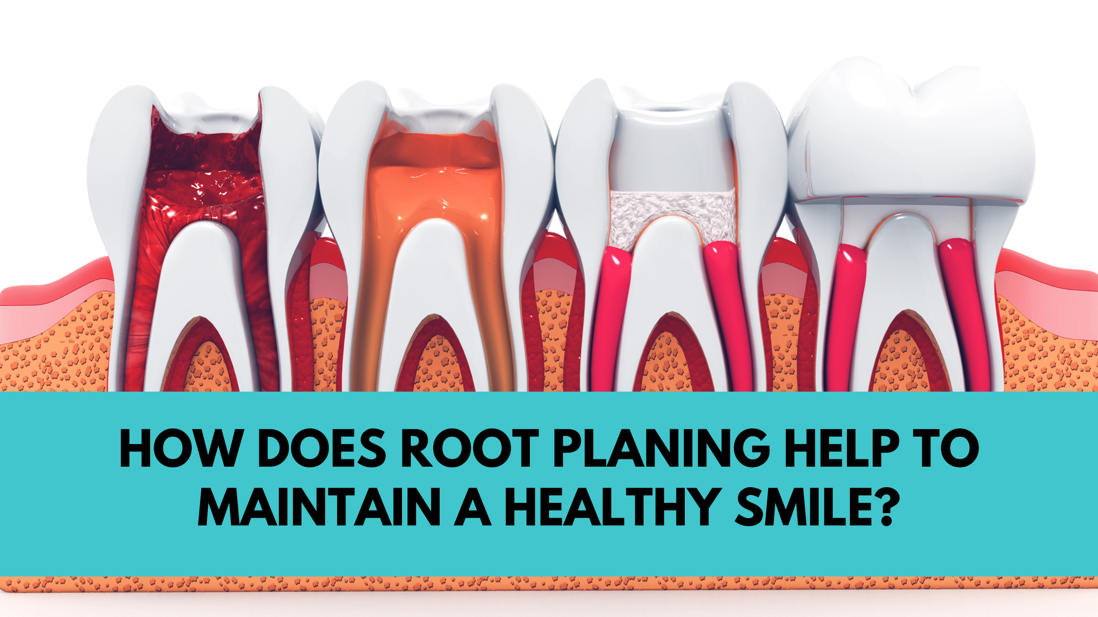 How Does Root Planing Help To Maintain A Healthy Smile 