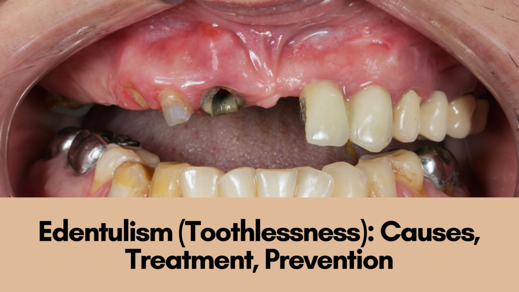 Edentulism (Toothlessness): Causes, Treatment, Prevention