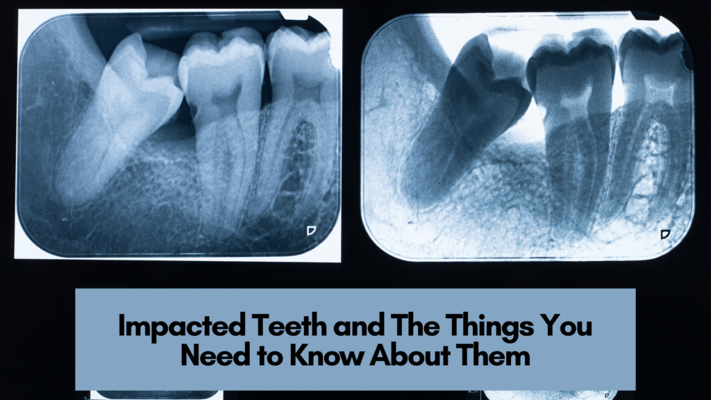 Impacted Teeth and The Things You Need to Know About Them