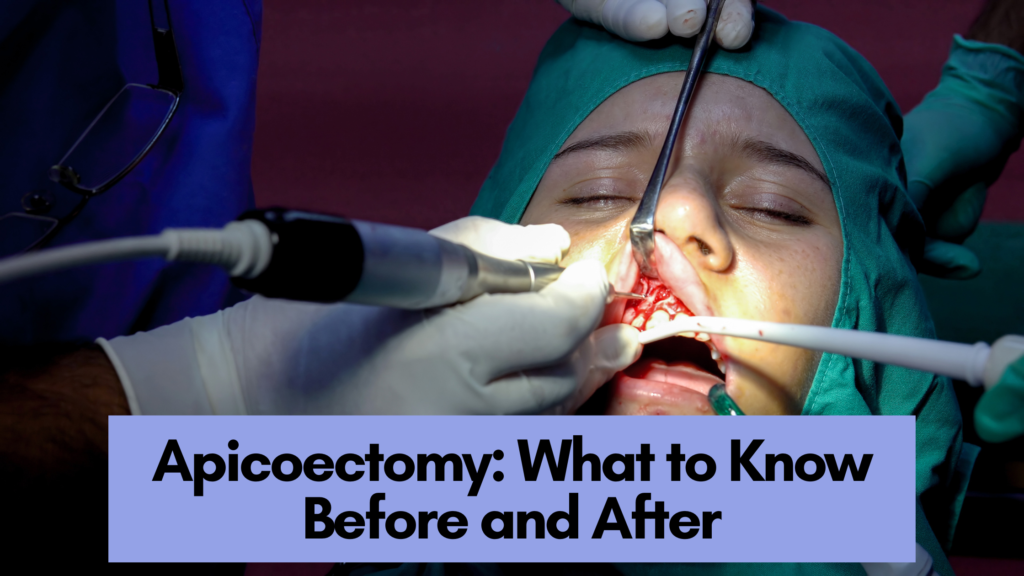 Apicoectomy: What to Know Before and After